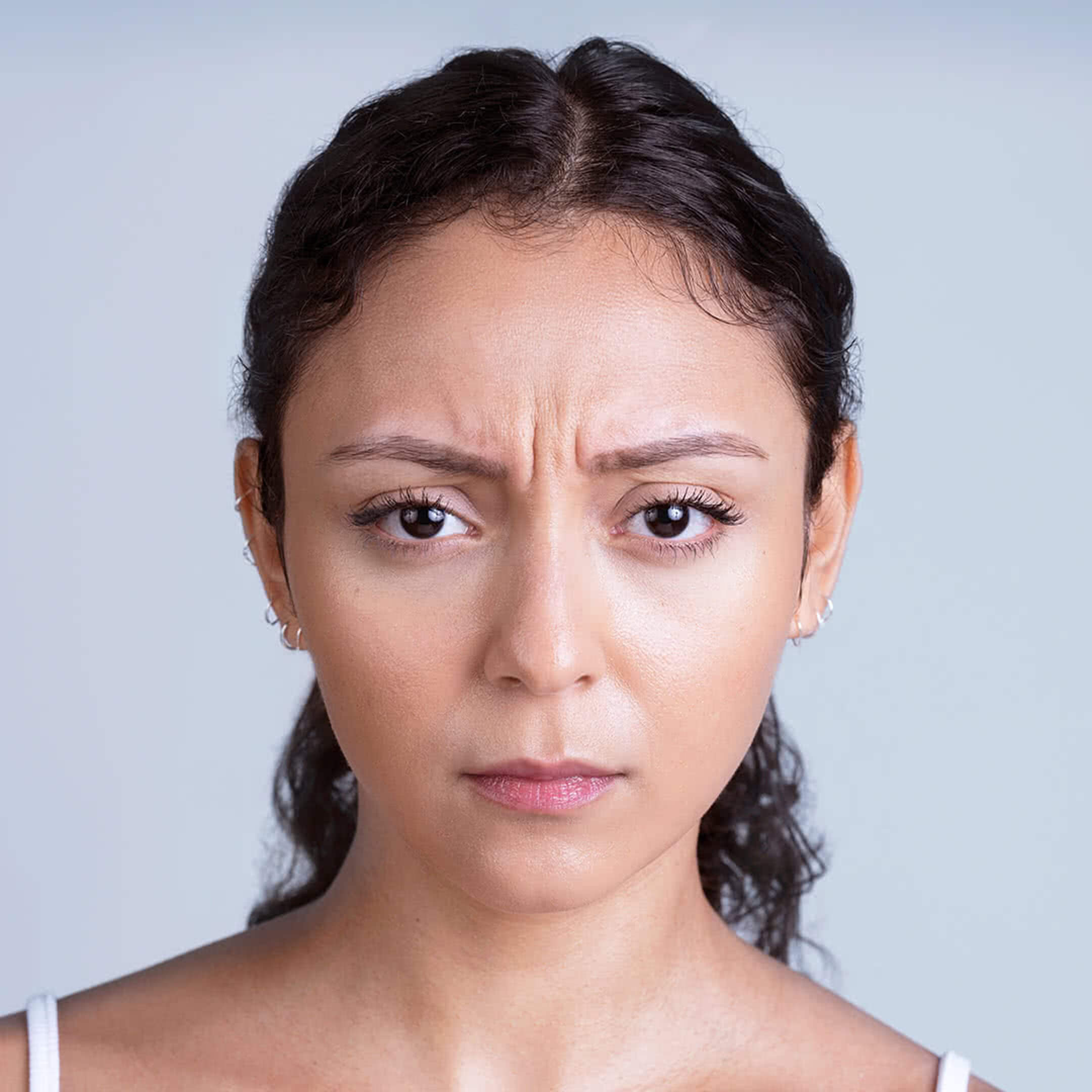 Frown Lines Before and After - Xeomin Aesthetic